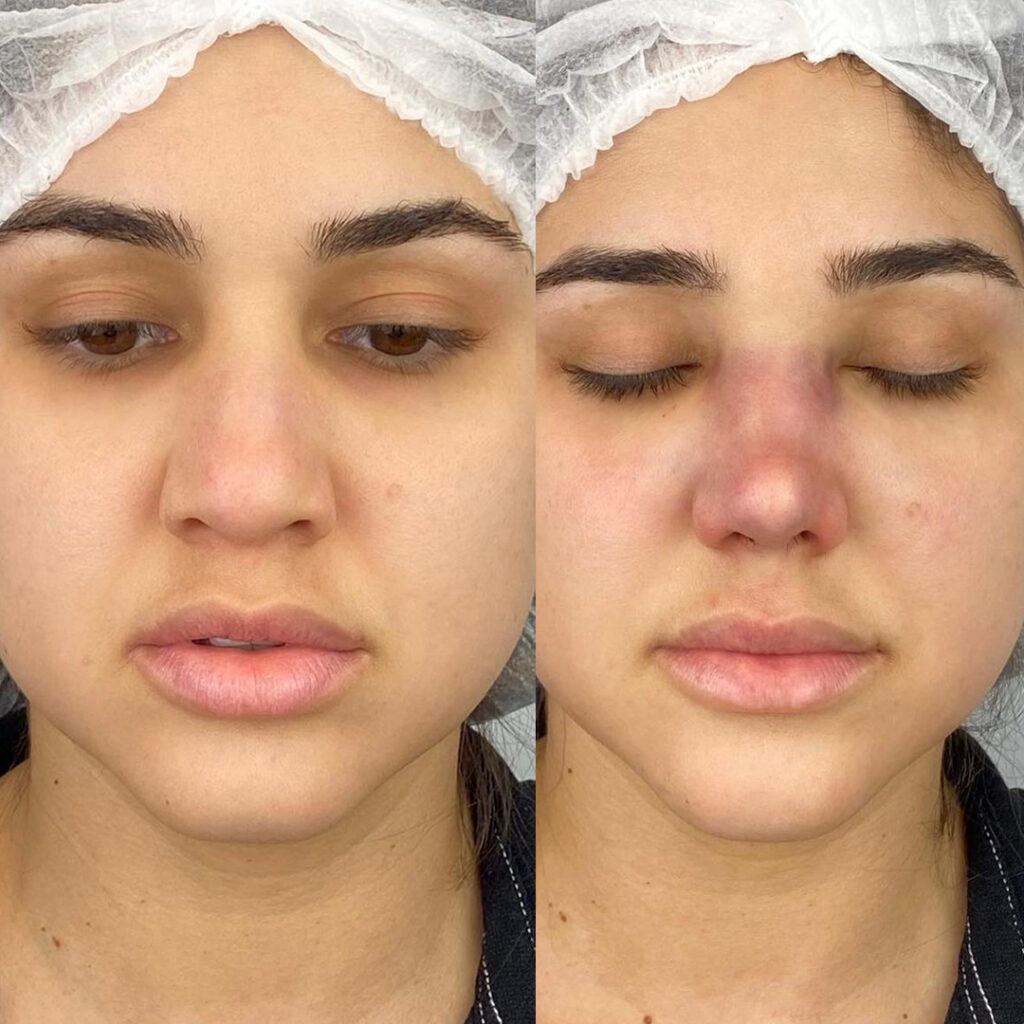 Rinomodelação Estruturada – Dr Bruno Bastos